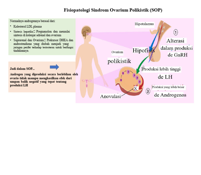 Fisiopatologi Sindrom Ovarium Polikistik (SOP) | PDF
