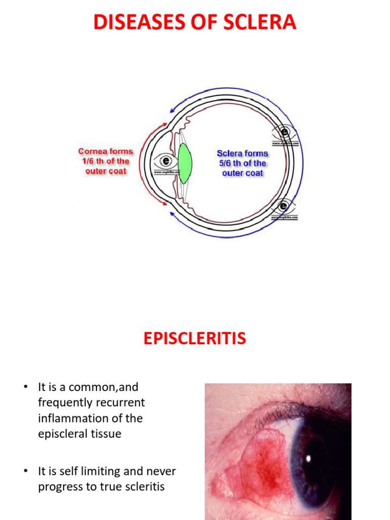 Diseases of Sclera | PDF | Diseases And Disorders | Medical Specialties
