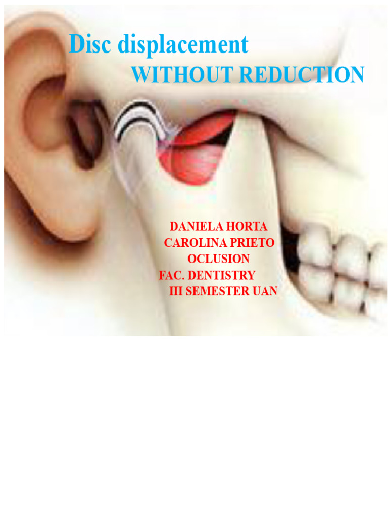 Disc Displacement Without Reduction | PDF | Diseases And Disorders ...