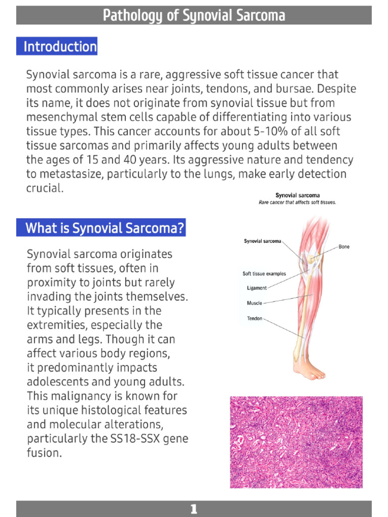 Synovial Sarcoma | PDF