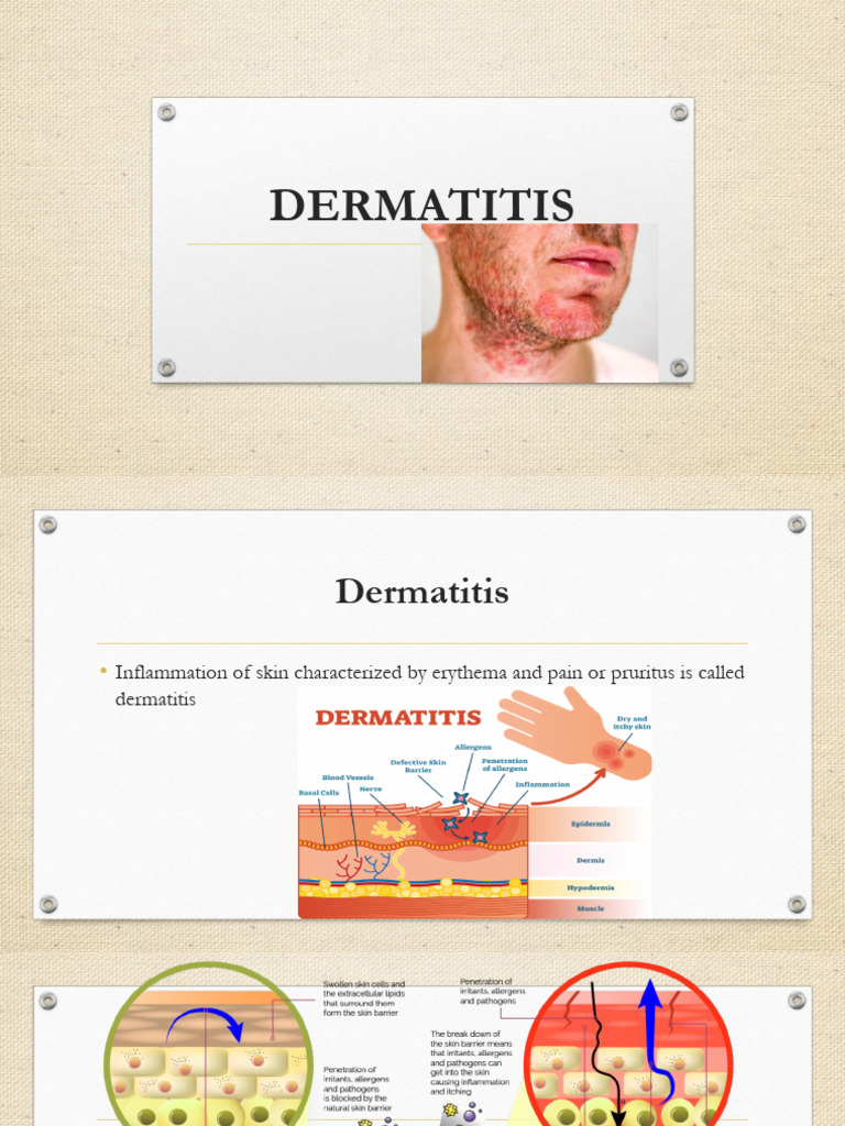 Types and Management of Dermatitis | PDF | Dermatitis | Allergy