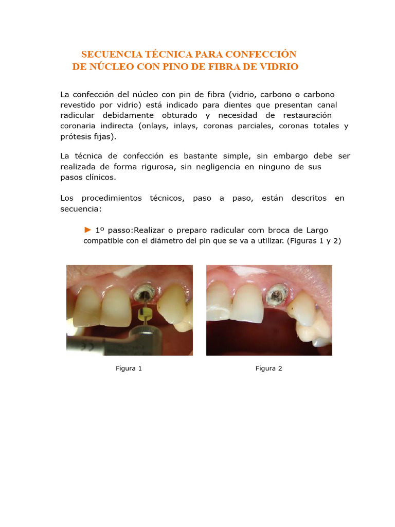 Técnica de Núcleo con Pino de Fibra | PDF | Materiales
