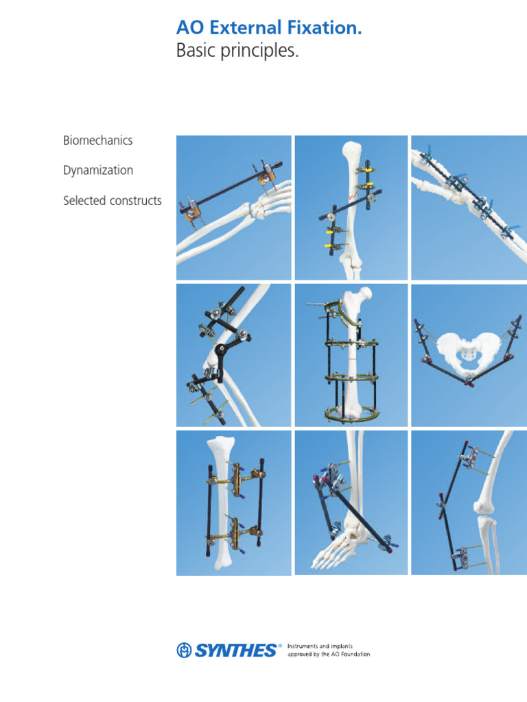 AO External Fixation: Principles & Techniques | PDF | Screw | Bone