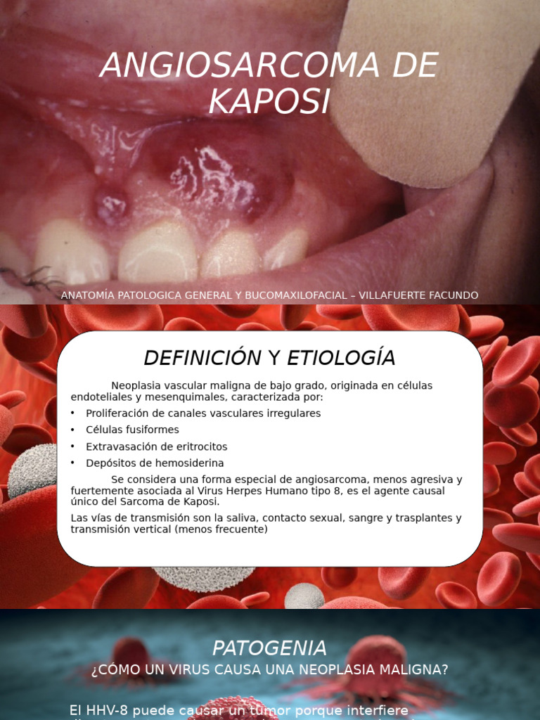 Sarcoma de Kaposi - Villafuerte Facundo | PDF | VIH / SIDA | VIH