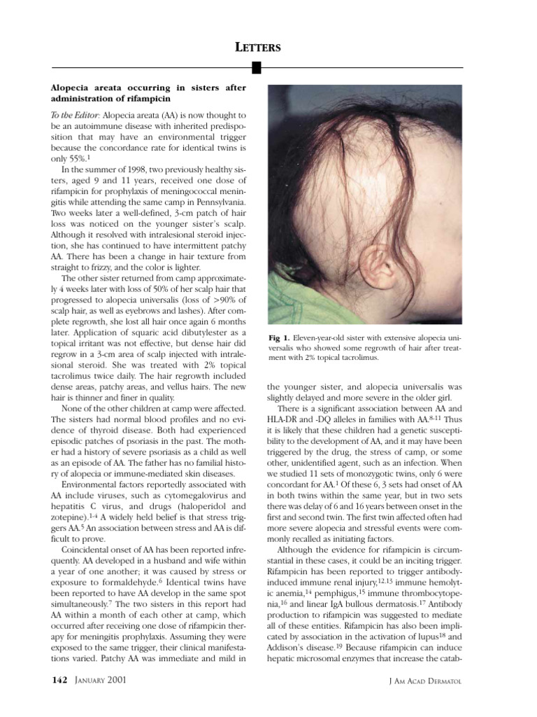 Alopecia Areata Occurring in Sisters After Adminis | PDF ...