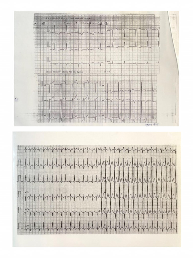 ECG Extra | PDF