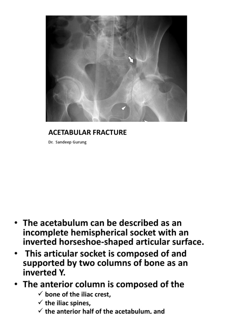 Acetabular Fracture Guide | PDF | Hip | Pelvis