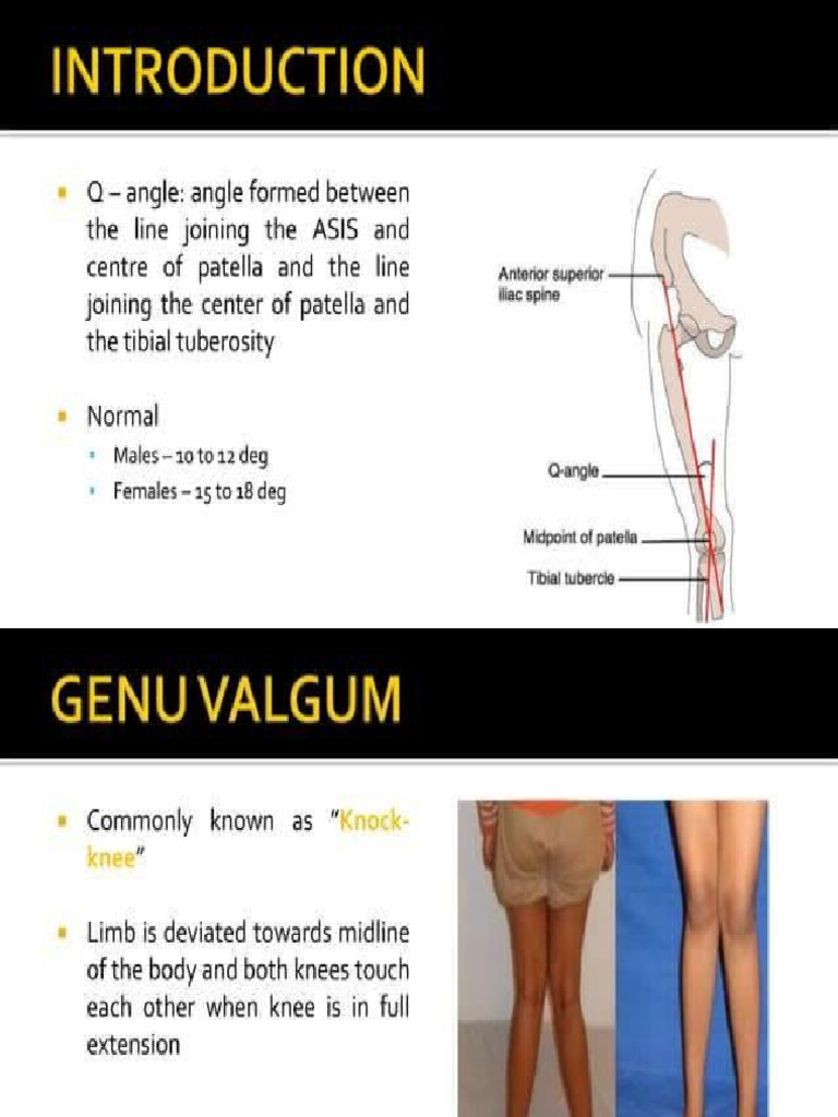 Genu Varum, Genu Valgus, Talipes Equino Varus and Valgus | PDF