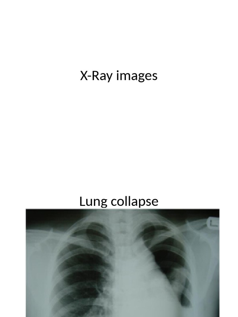 X-Ray Findings in Lung Conditions | PDF