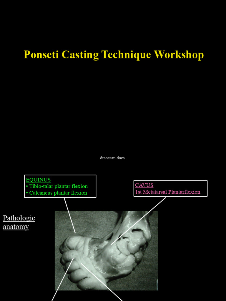 Ponseti Casting Technique Workshop | PDF | Foot | Anatomical Terms Of ...