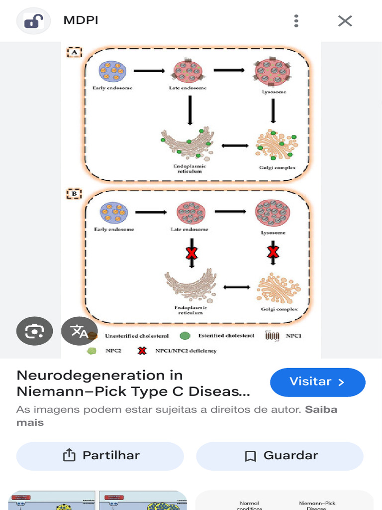 Etiologia Da Doenca de Niemann Pick Tipo c - Pesquisa Google | PDF