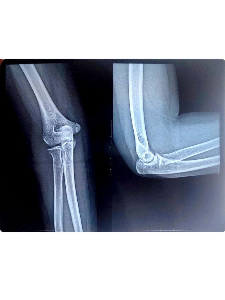 Elbow Joint X-ray | PDF