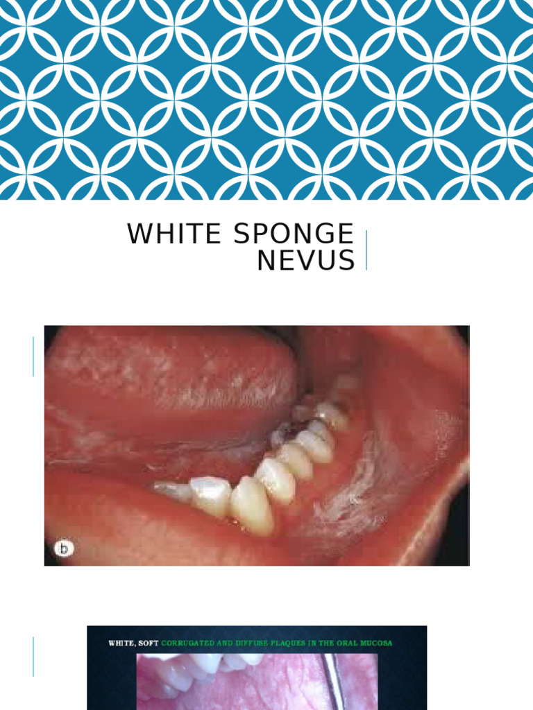 White Sponge Nevus | PDF