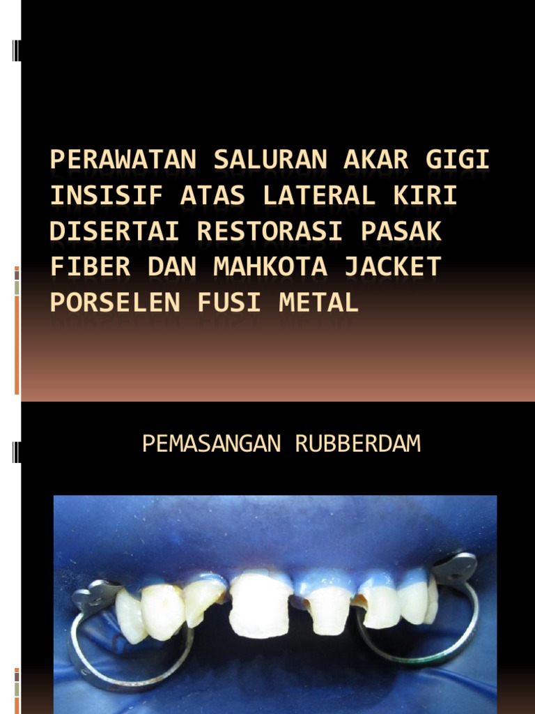 Perawatan Saluran Akar Gigi Insisif Atas Lateral Kiri | PDF