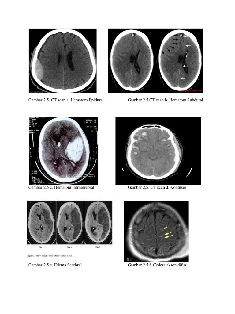 CT Scan Brain Injury Types | PDF