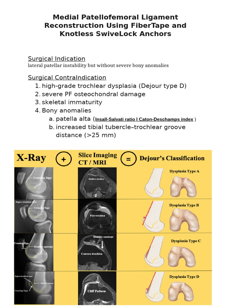 Medial Patellofemoral Ligament Reconstruction Using FiberTape and ...