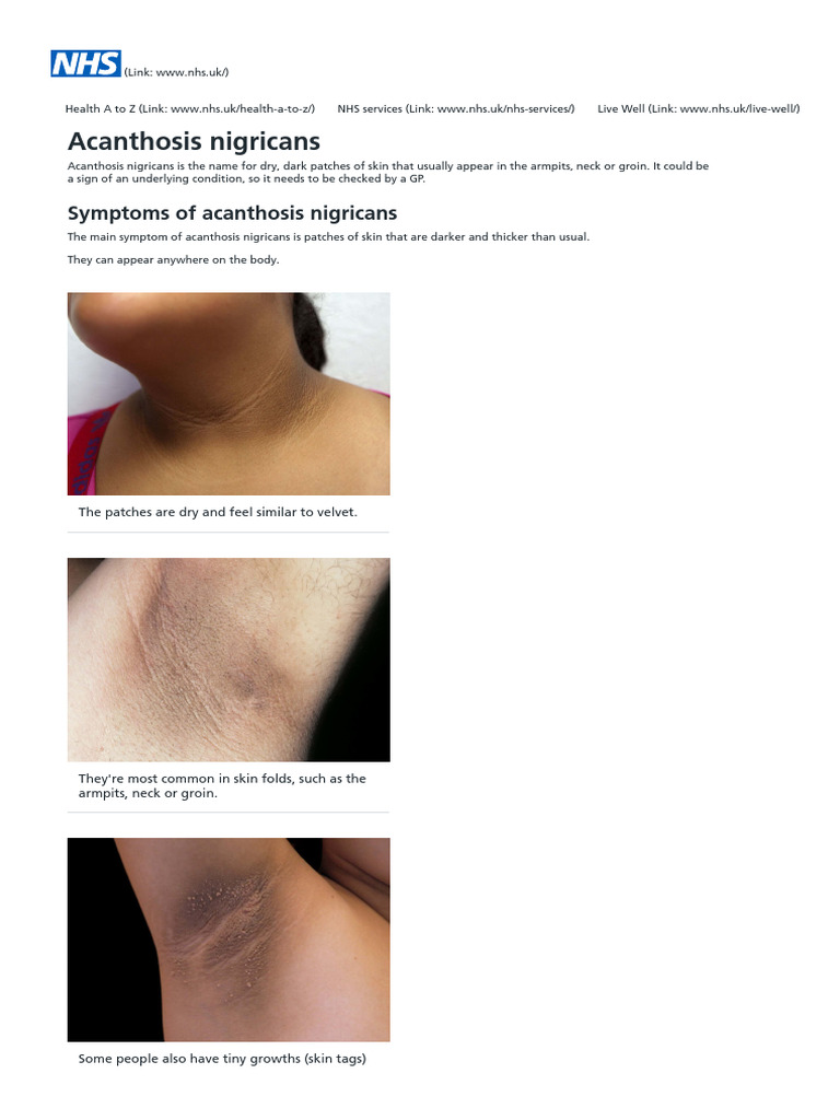 Acanthosis Nigricans - NHS | PDF | Endocrinology | Endocrine
