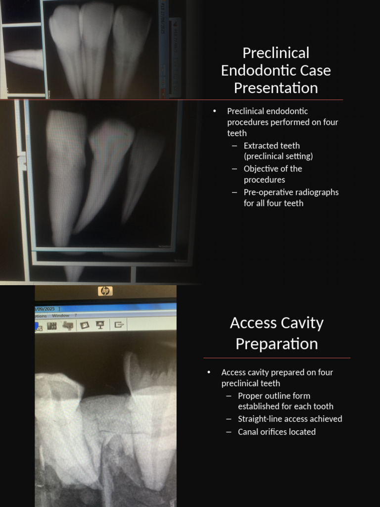 Preclinical Endodontic Procedures Overview | PDF