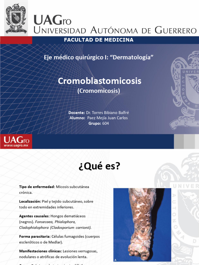 Cromomicosis JCPM | PDF | Especialidades Medicas | Medicina CLINICA
