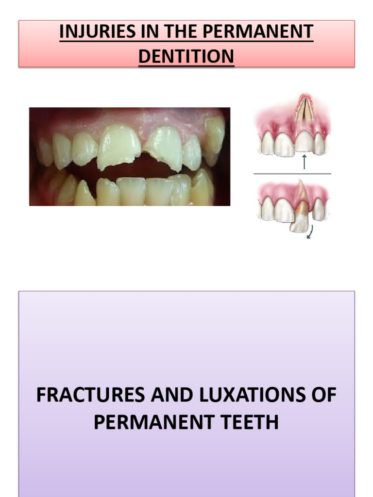 Traumatic Injuries in Permanent Dentition (1) | PDF | Human Tooth ...