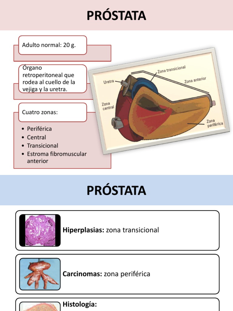 Histología y patologías de la próstata | PDF | Cancer de prostata ...