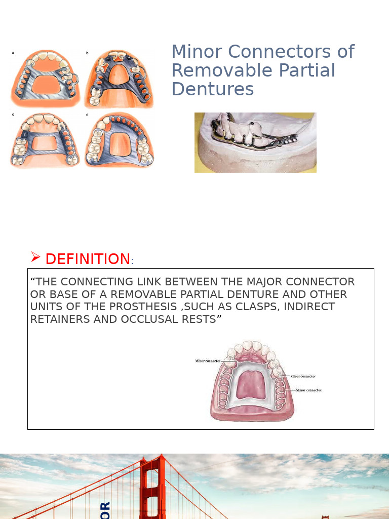 Minor Connectors of Removable Partial Denture | PDF | Dentures | Dental ...