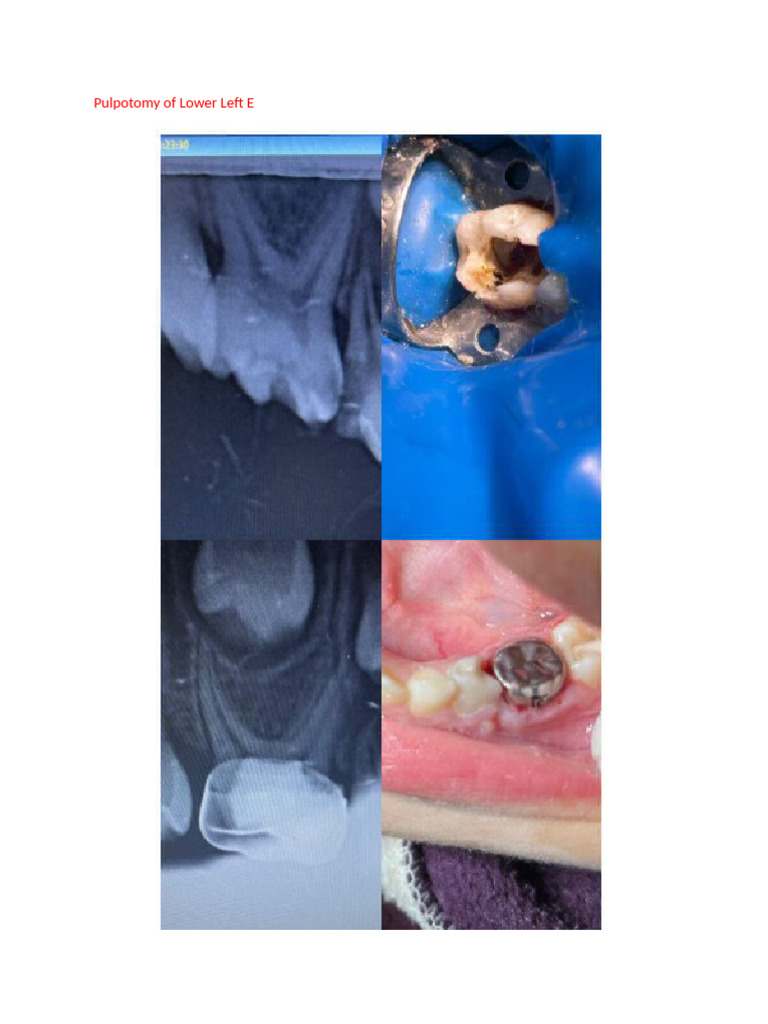 Pulpotomy and Pulpectomy of Teeth E | PDF