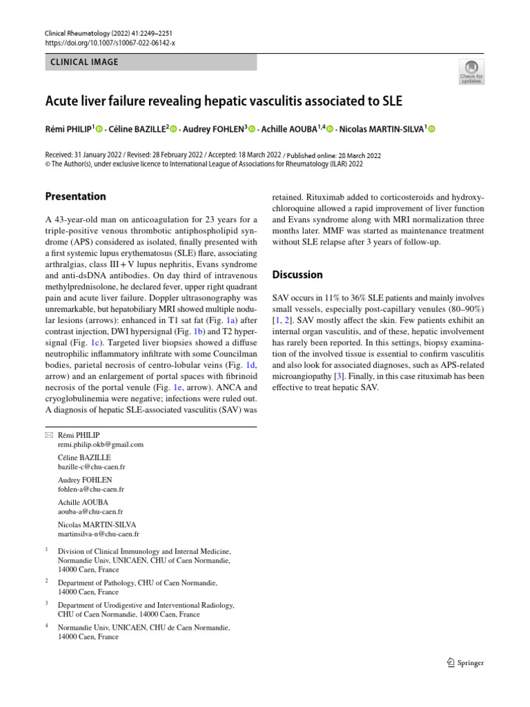 Acute Liver Failure Revealing Hepatic Vasculitis Associated To SLE ...