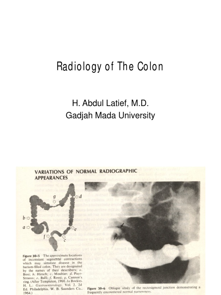 Radiology of The Colon | PDF