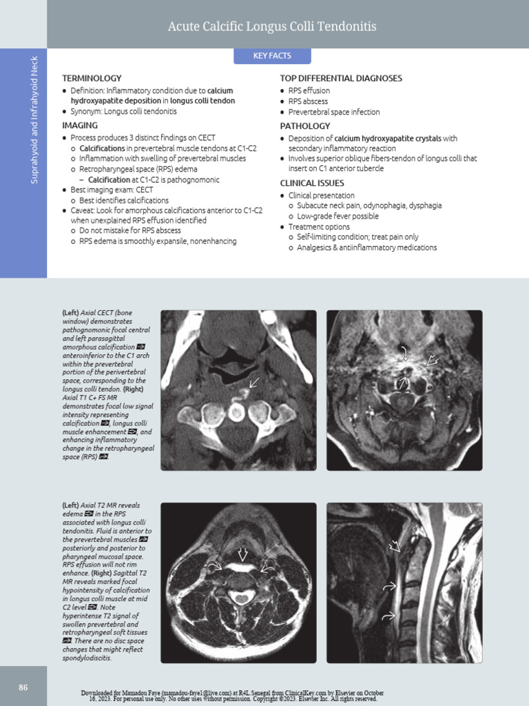Acute Calcific Longus Colli Tendonitis | PDF | Edema | Inflammation