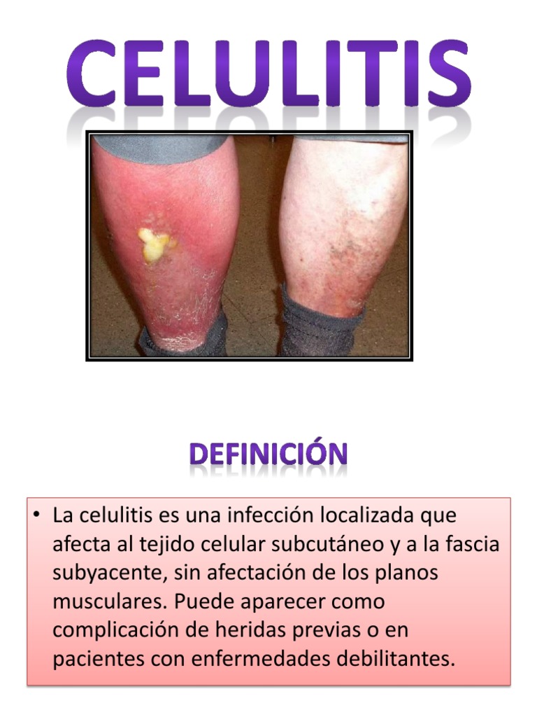 celulitis
