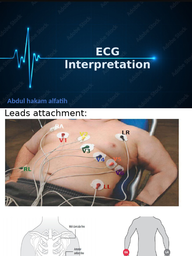 ECG Interpretation Guide and Analysis | PDF | Electrocardiography ...