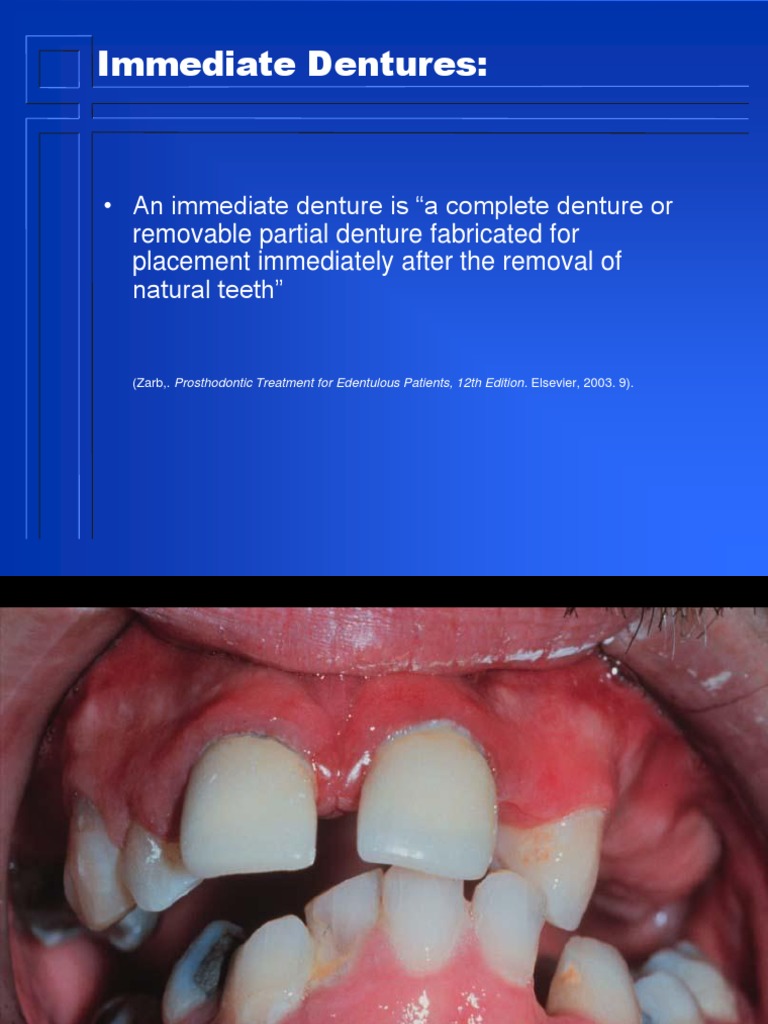 Immediate Denture | PDF | Dentures | Medicine