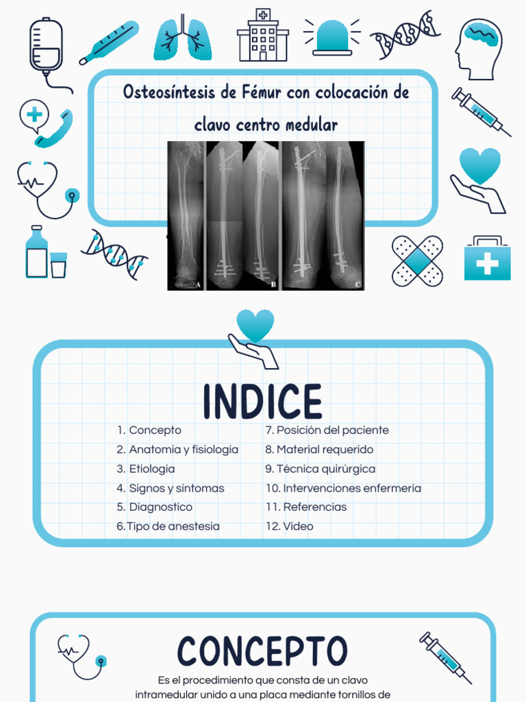 Osteosíntesis de Fémur: Clavo Intramedular | PDF | Hueso | Fractura
