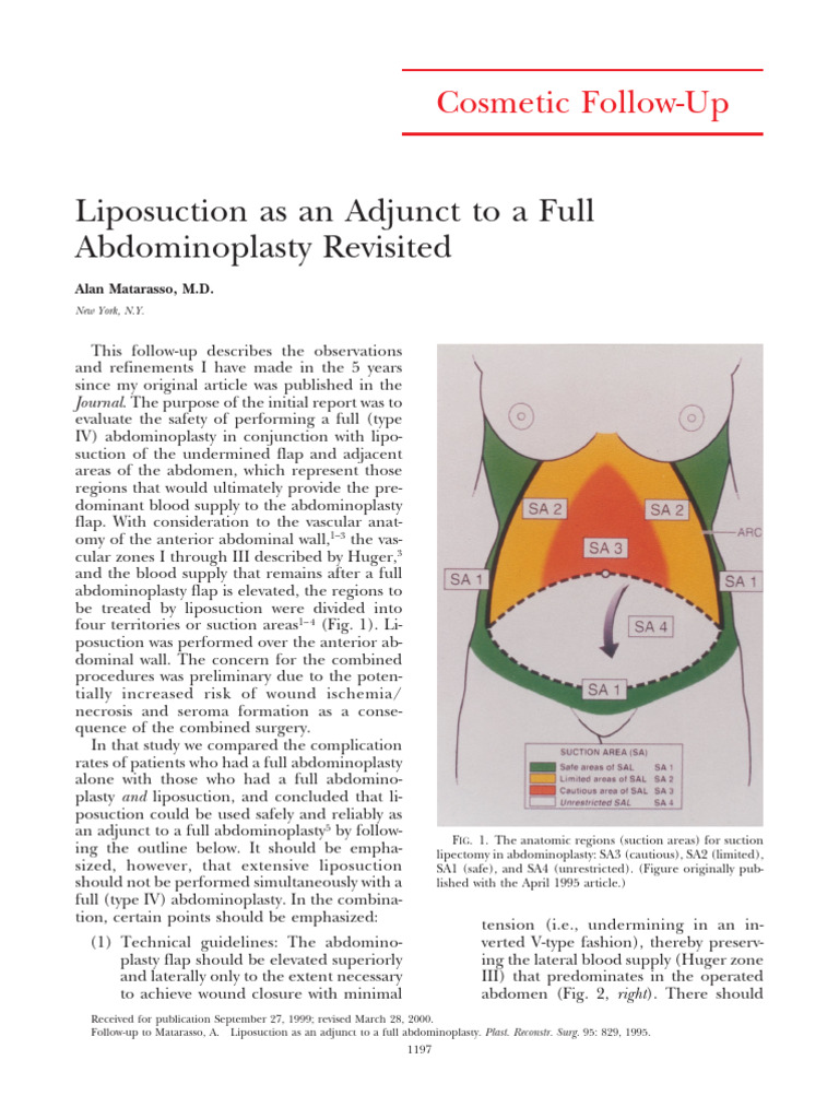 5 Matarasso Liposuction as an Adjunct to a Full Abdominoplasty ...