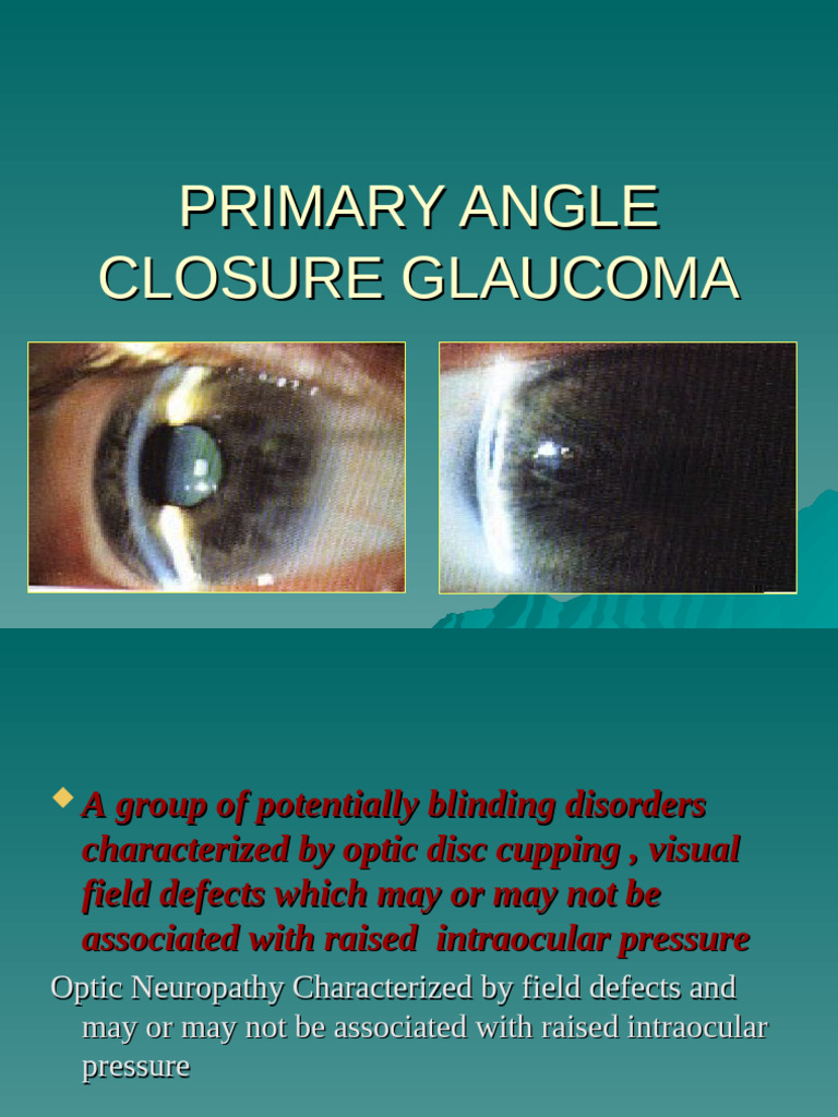 Primary Angle Closure Glaucoma-lecture | PDF | Glaucoma | Vision