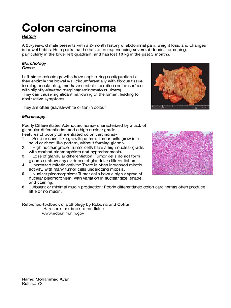 Poorly Differentiated Colon Carcinoma | PDF