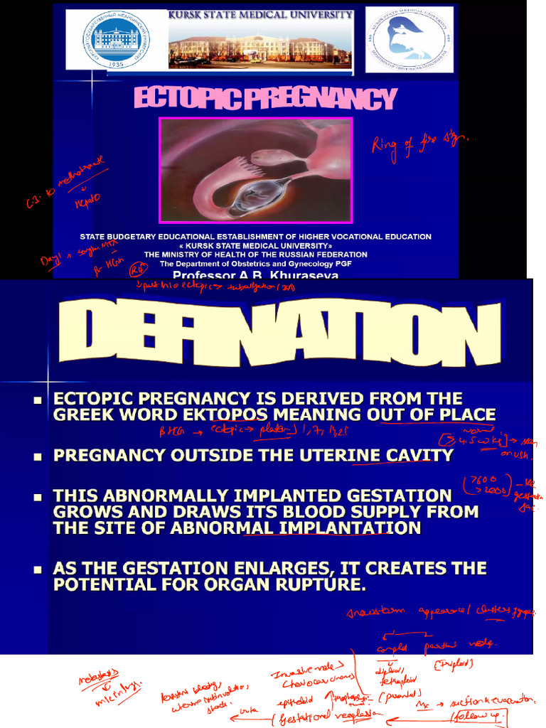 Ectopic Pregnancy | PDF