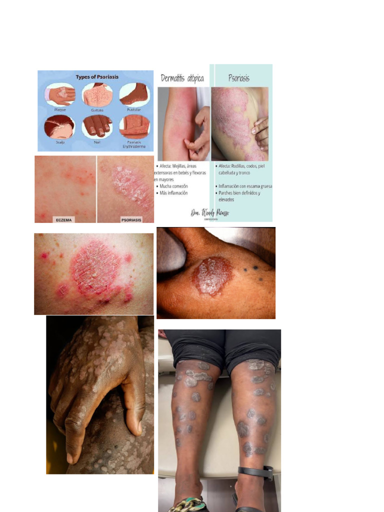 Derma Psoariasis | PDF