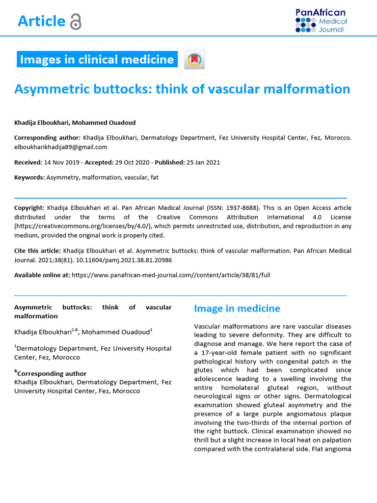 Asymmetric Buttocks and Vascular Malformation | PDF | Medical ...