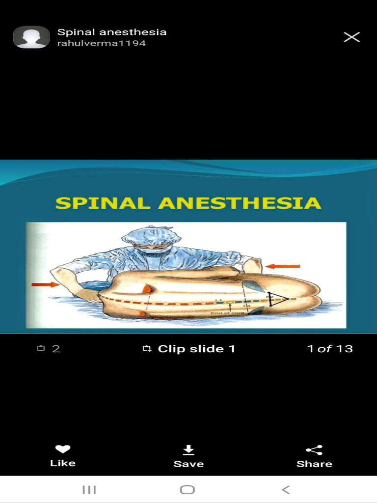 Spinal Anesthesia | PDF