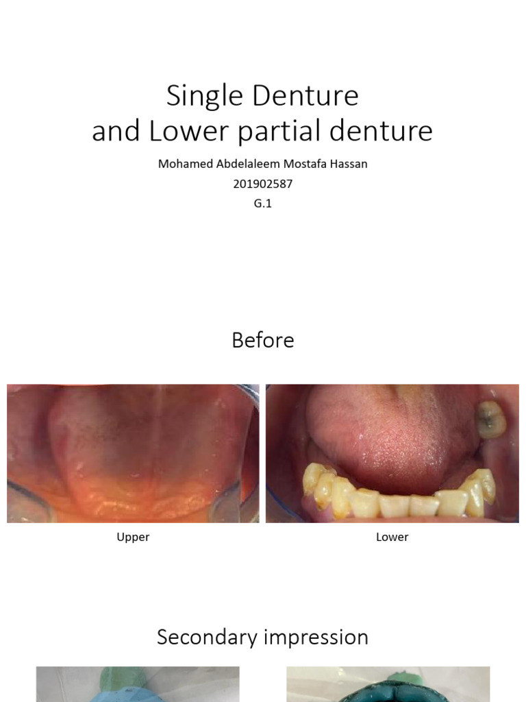 Single Denture and Lower Partial Denture Elwy | PDF