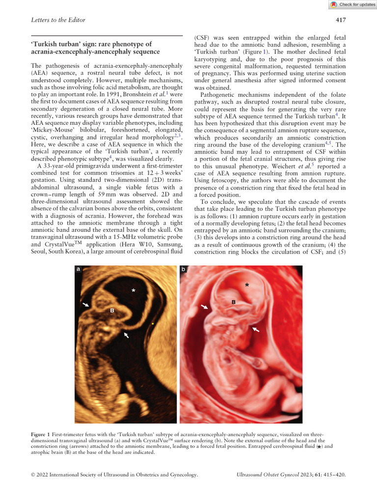 Ultrasound in Obstet Gyne - 2022 - Tonni - Turkish Turban Sign Rare ...