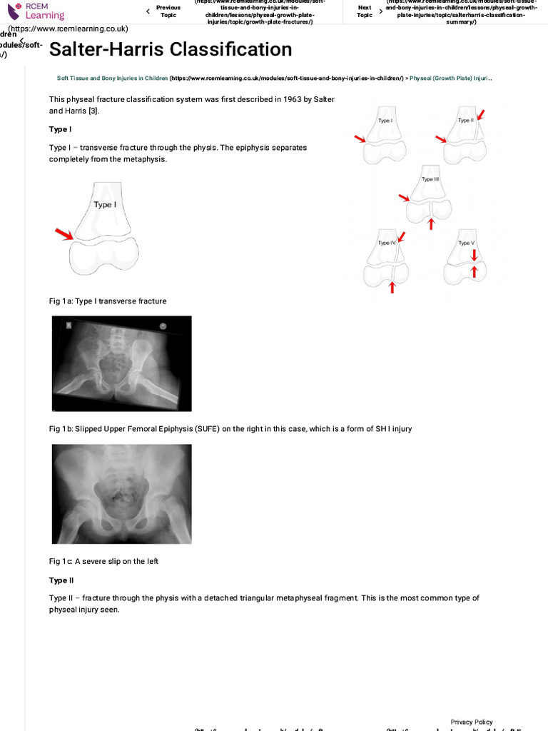 Salter-Harris Classification - RCEMLearning | PDF | Injury ...