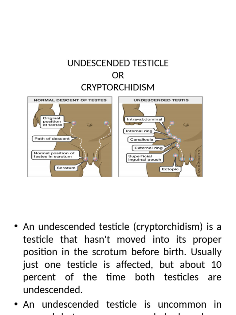 Undescended Testicle | PDF | Testicle | Clinical Medicine