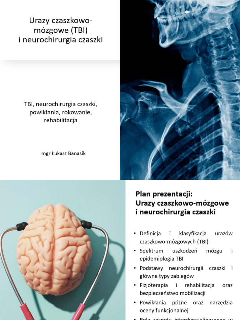 Urazy Czaszkowo Moì Zgowe WSEI | PDF