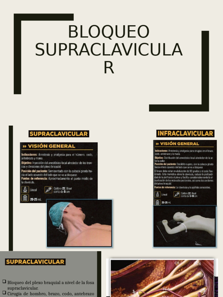 Bloqueo Supraclavicular del Plexo Braquial | PDF