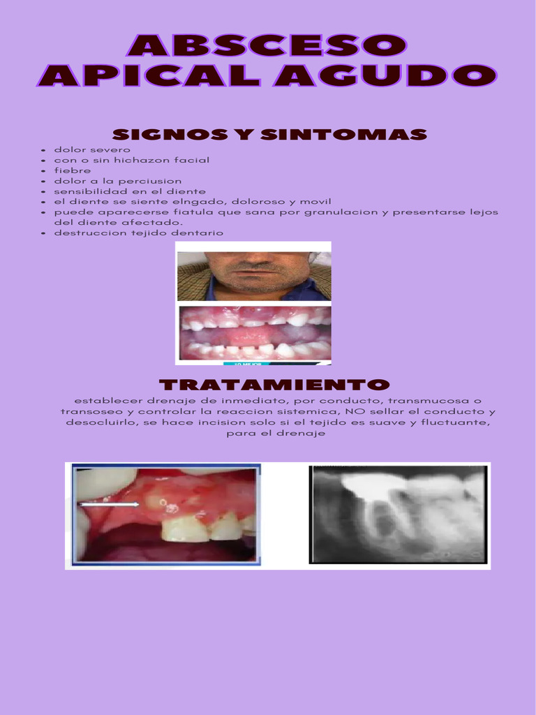 Absceso Apical Agudo - 20260129 - 014116 - 0000 | PDF