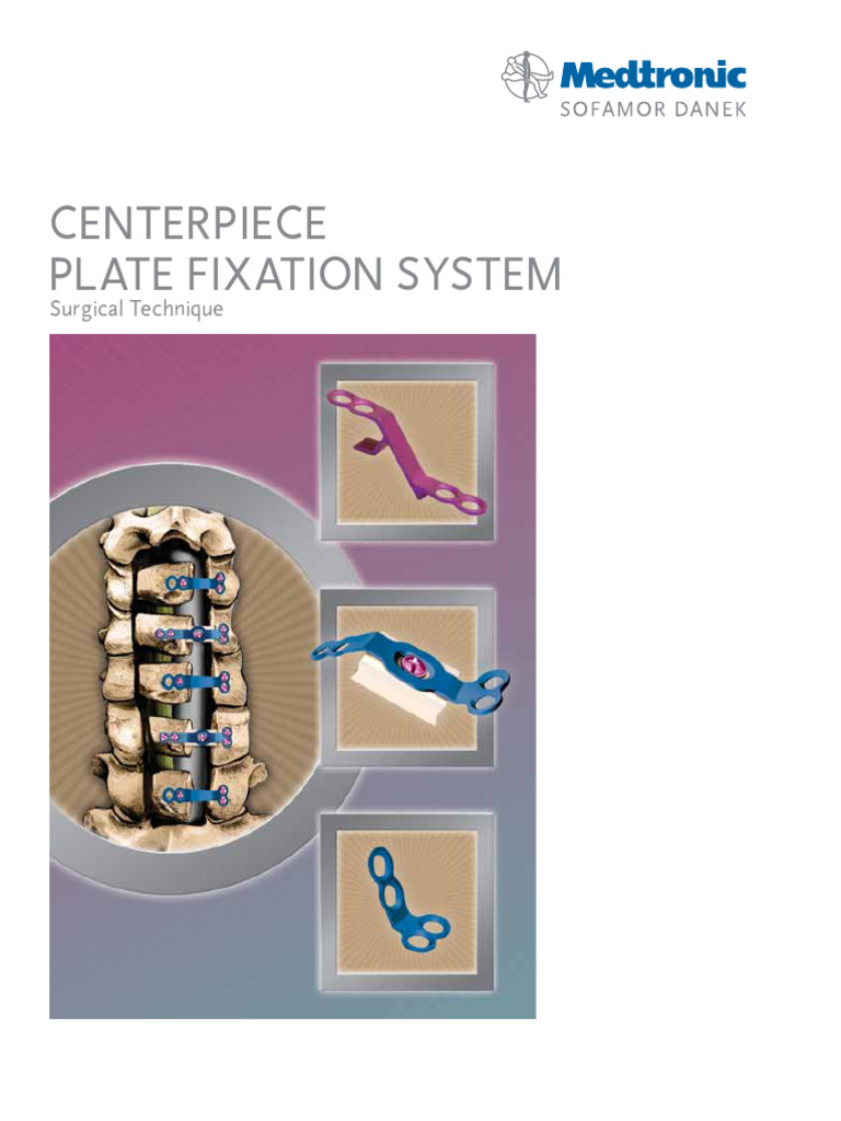 Centerpiece Plate Fixation System. Surgical Technique | PDF | Implant ...