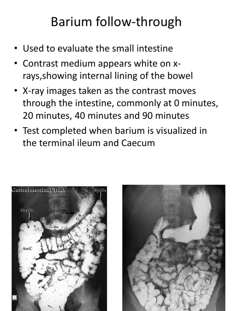 Barium Follow-Through TBL | PDF | Crohn's Disease | Peptic Ulcer
